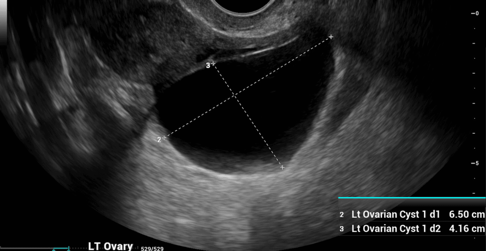 Simple Ovarian Cysts IAME Simple Ovarian Cysts IAME
